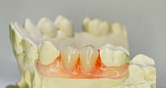 Adjusting To Your New Partial Denture – The Clear Guard