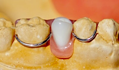 The Clear Guard Acrylic Partial Denture, Includes 1 Tooth