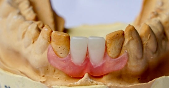 Flexible Partial Denture, Includes 1 tooth – The Clear Guard